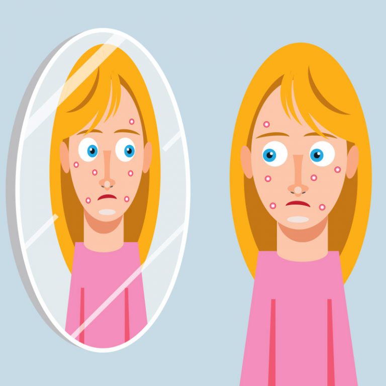 Pimples on Face - Dana’s Acne Story - All About Acne