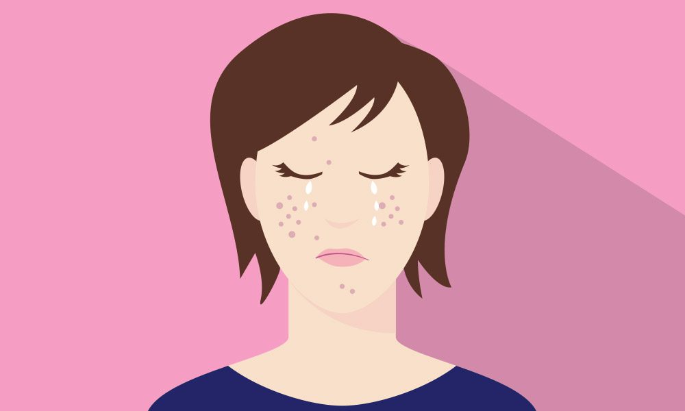 Acne Emotions | Acne and Mental Health | All About Acne