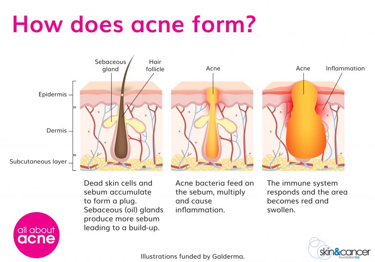 What Causes Acne - Acne Causes - All About Acne