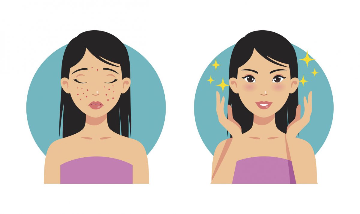 How to get rid of pimples fast - All About Acne