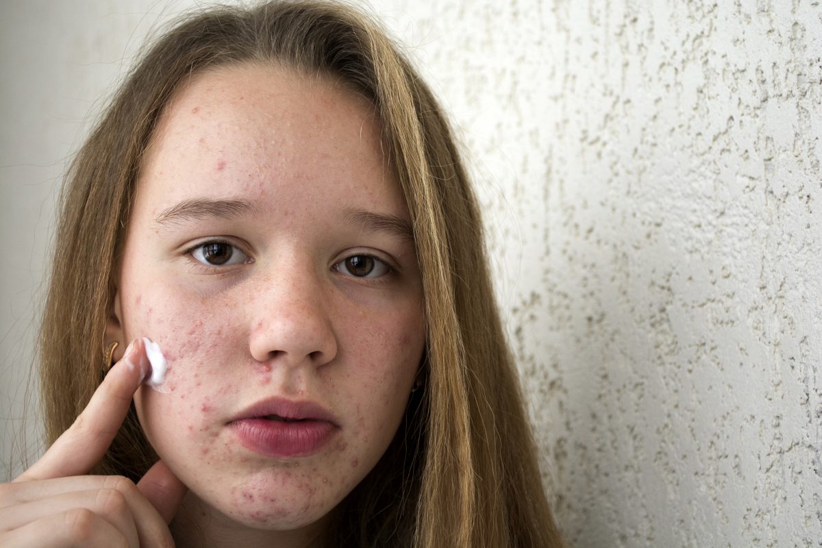 People With Acne Are Frustrated By Conflicting Acne Treatment Advice