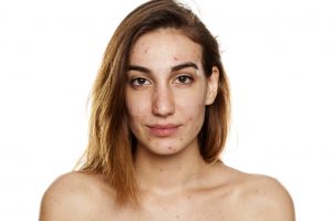 How To Get Rid Of Pimples - All About Acne - Australia