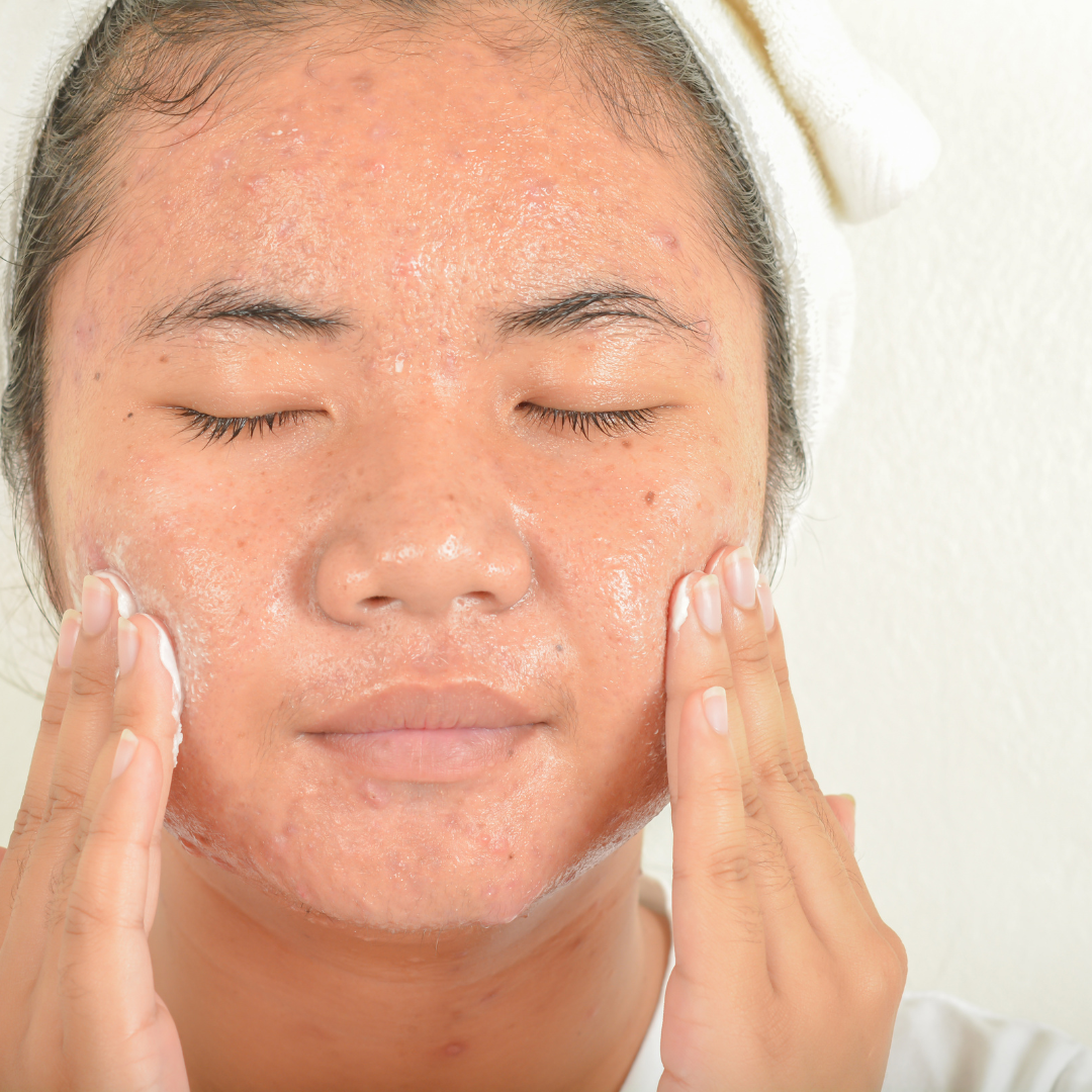Acne treatments can coexist with sensitive skin - All About Acne