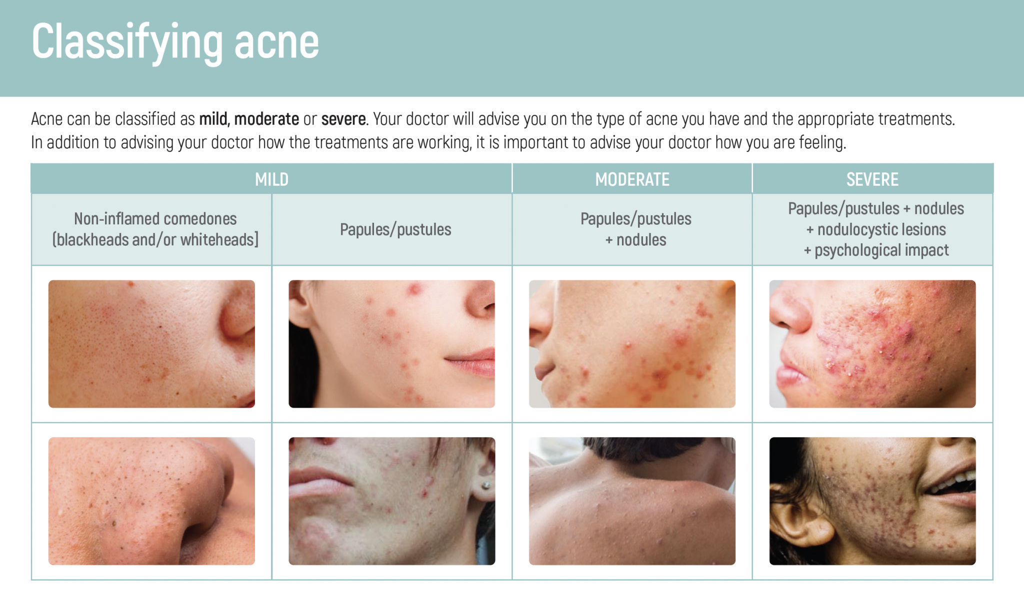 Types Of Acne - Types of Pimples - All About Acne